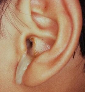Repair of CSF leak from the ear in Iran with Dr. Saeedi | ENT Surgeon